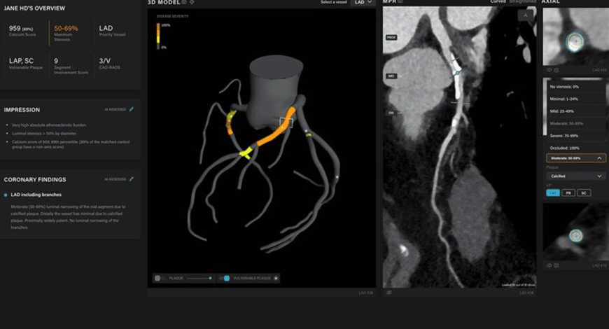 Artrya to roll out AI heart disease detecting tool - Medical Buyer