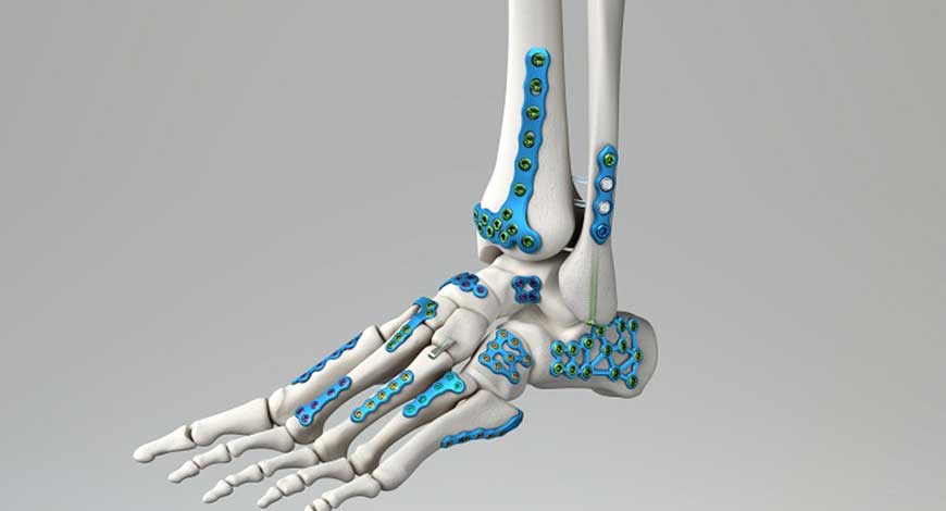 Medline unveils plating and implant solutions in US - Medical Buyer