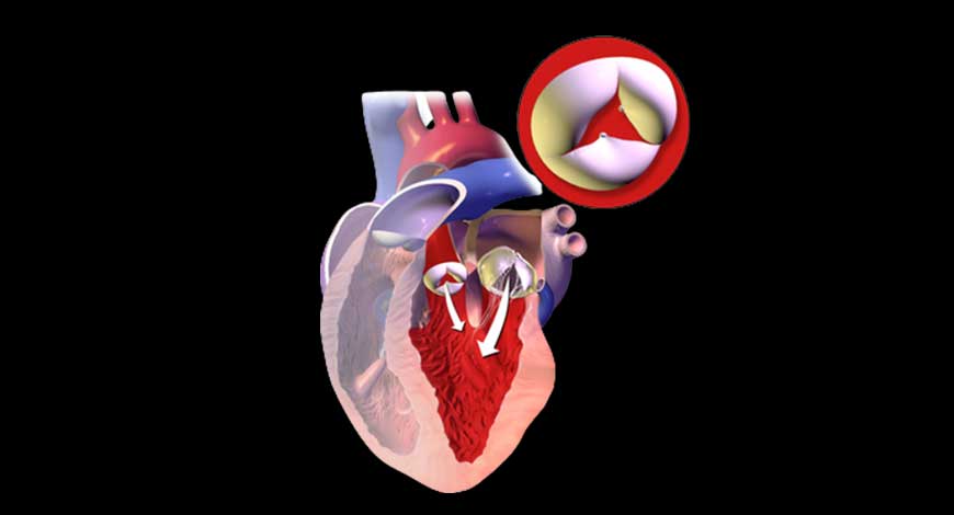 Mathematical relationship between aortic valve, AR to guide AV repair ...